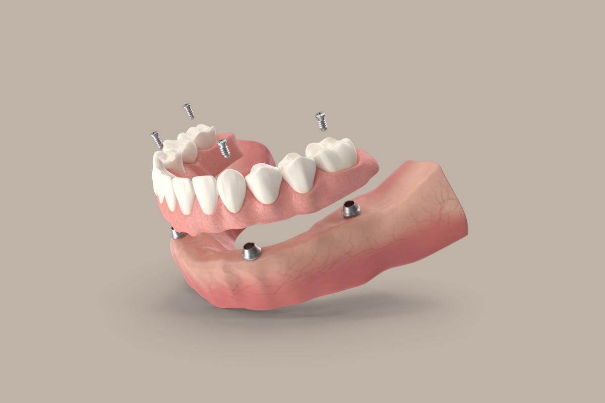 Dentures vs Bridges: Best Fix for Chewing Issues